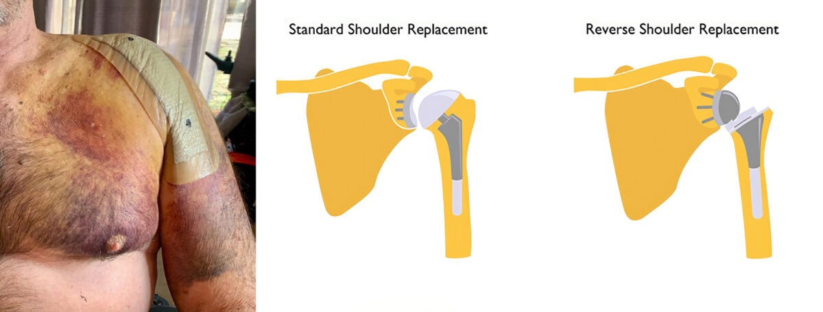 My Search for the Best Treatment Option When My Shoulders Went South ...